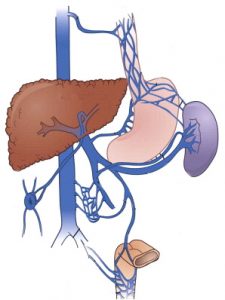 Varizes de esôfago - Progastro