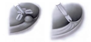 Polipectomia - Progastro